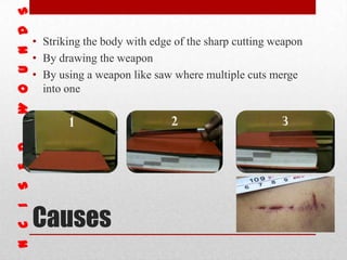 Mechanical injuries_Forensics | PPTX