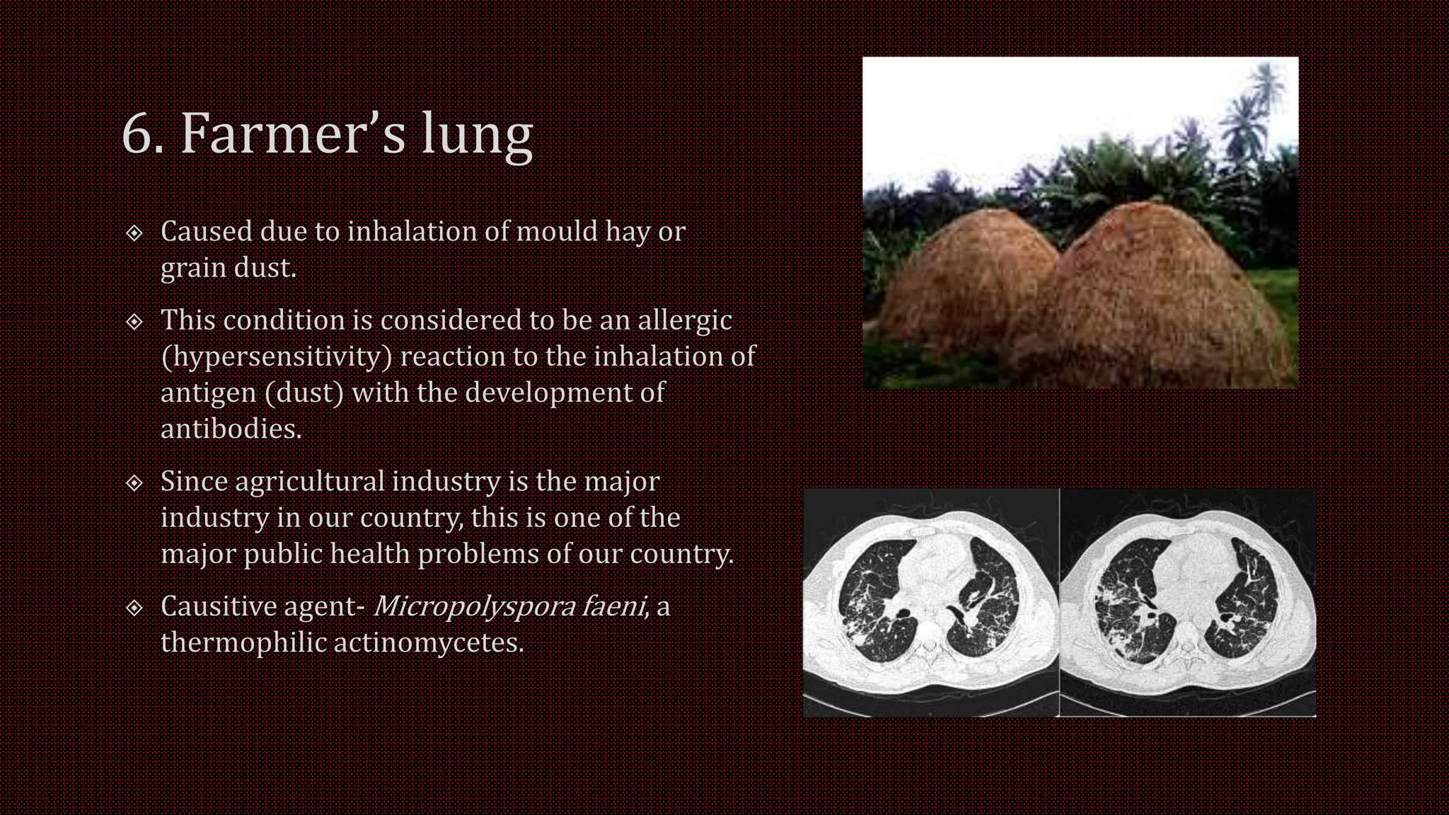 Occupational Diseases (Part 1) - Pneumoconioses | PPT