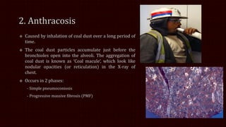 Occupational Diseases (Part 1) - Pneumoconioses | PPTX