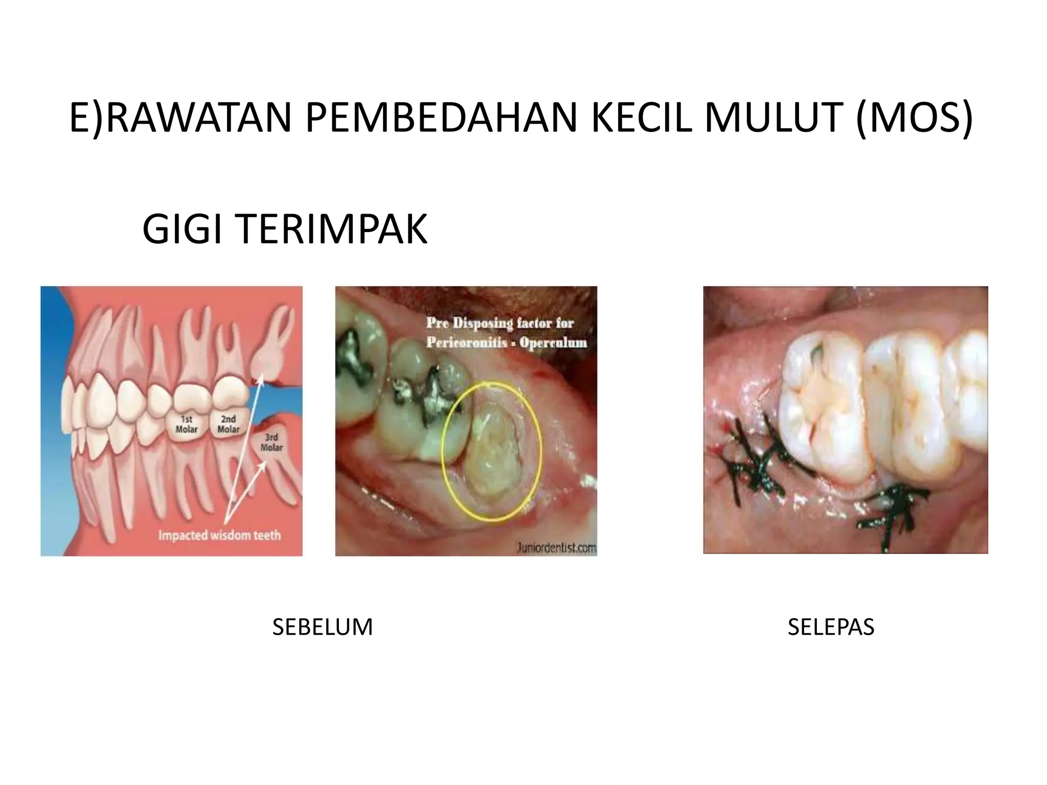 Perkhidmatan Pesakit Luar Di Klinik Pergigian Labuan | PPTX
