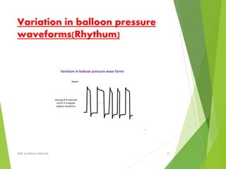 Intra Aortic Balloon Pump by Rubina Shehzadi RN | PDF