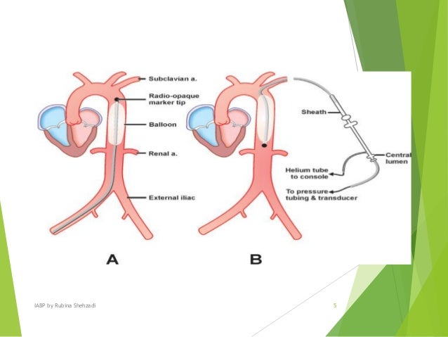 Intra Aortic Balloon Pump by Rubina Shehzadi RN