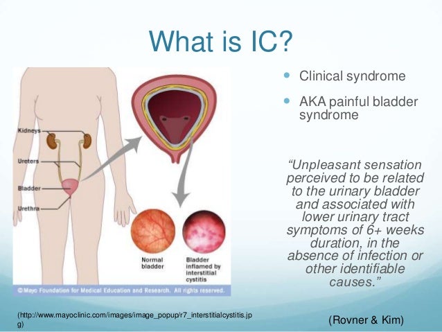 Interstitial Cystitis