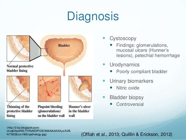Interstitial Cystitis