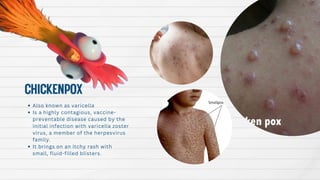 Chicken pox with memes ahdhcjxlsosjncmcm | PDF