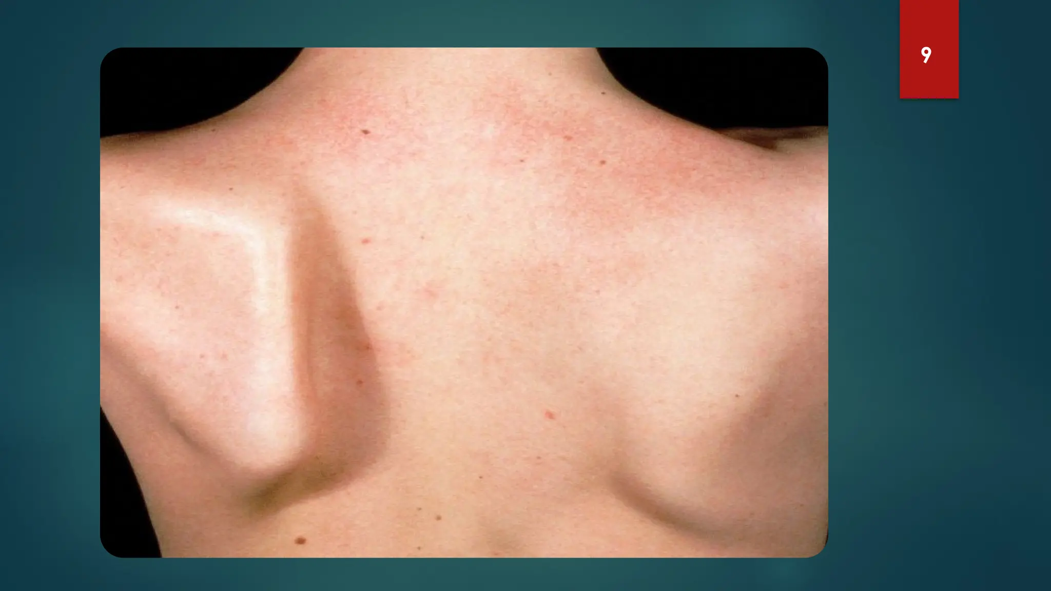 Presentation on Dorsal Scapular Nerve. power point docx.pptx