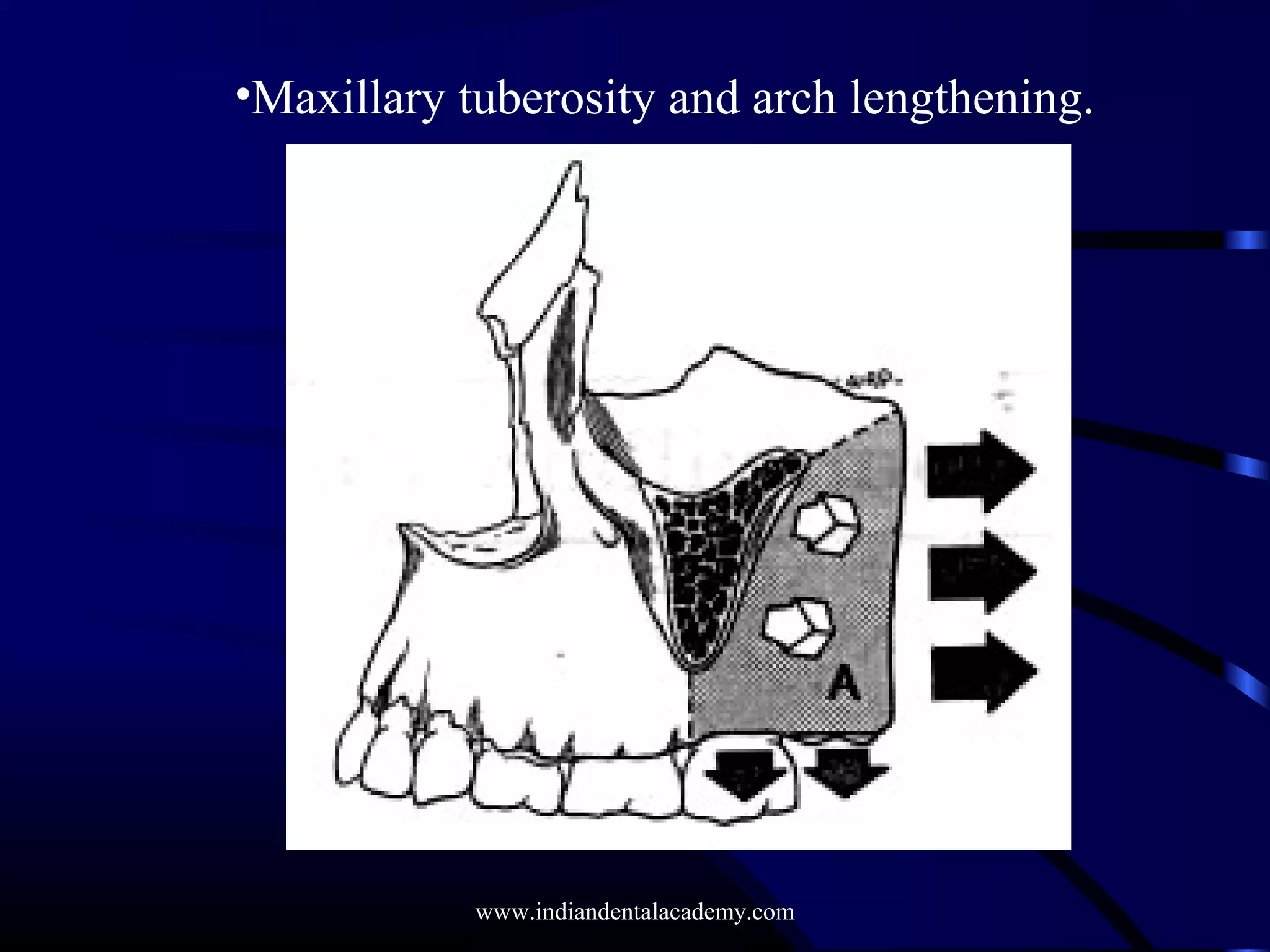 Growth and development of maxilla and maxillary sinus/ dental courses | PPT