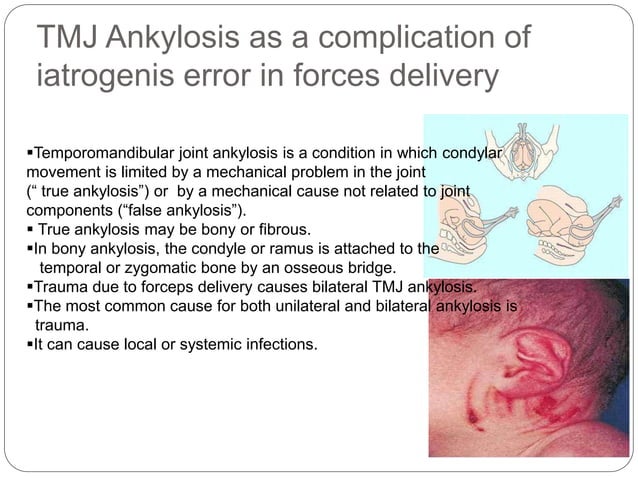 GROWTH AND DEVELOPMENT OF TEMPOROMANDIBULAR JOINT.pptx | Pregnancy ...