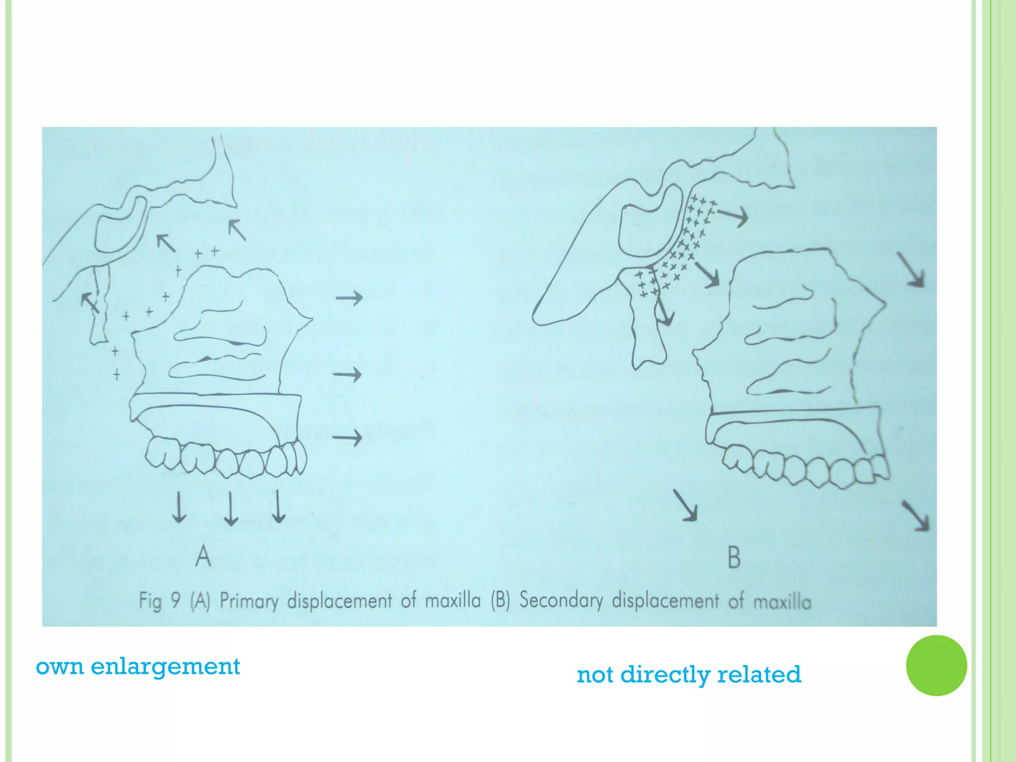 Growth & development of maxilla and mandible | PPT