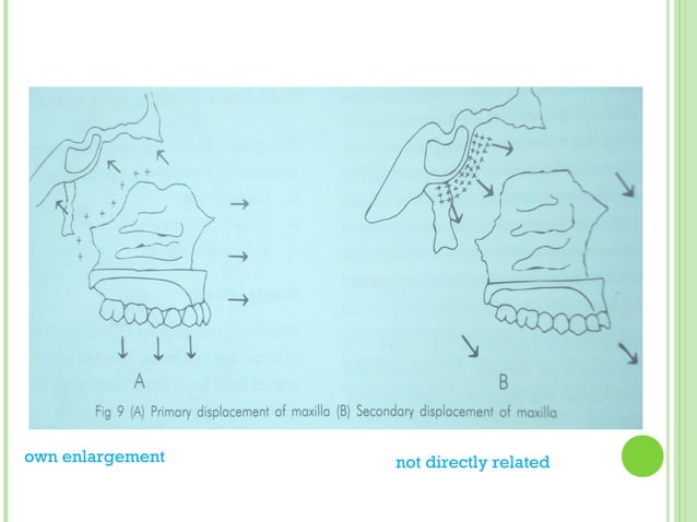 Growth & development of maxilla and mandible | PPT | Ear, Nose and ...