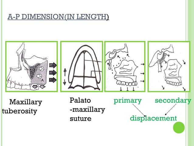 Growth & development of maxilla and mandible | PPT | Ear, Nose and ...