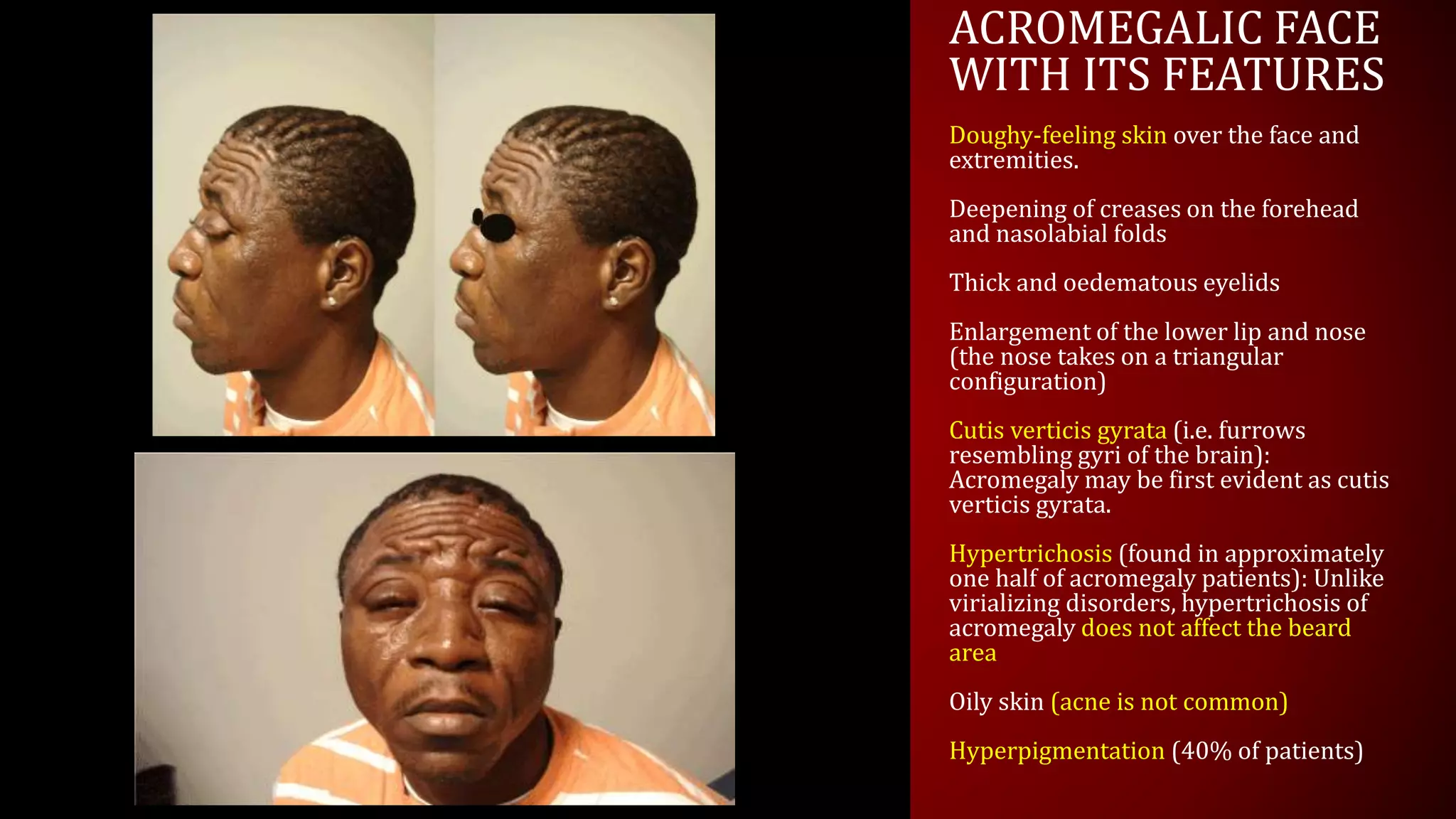 Growth hormone its deficiency and excess | PPTX