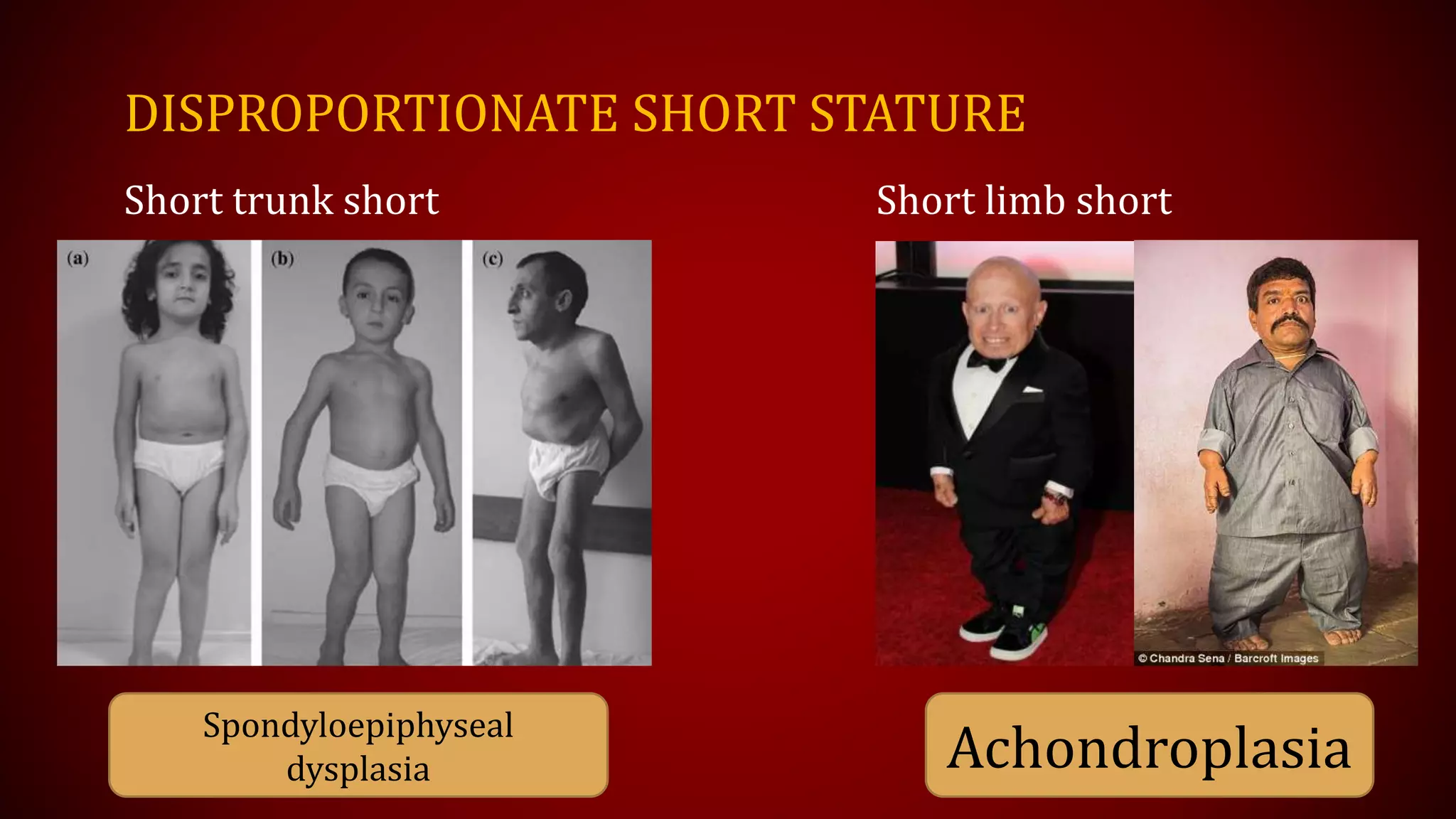 Growth Hormone Its Deficiency And Excess Ppt