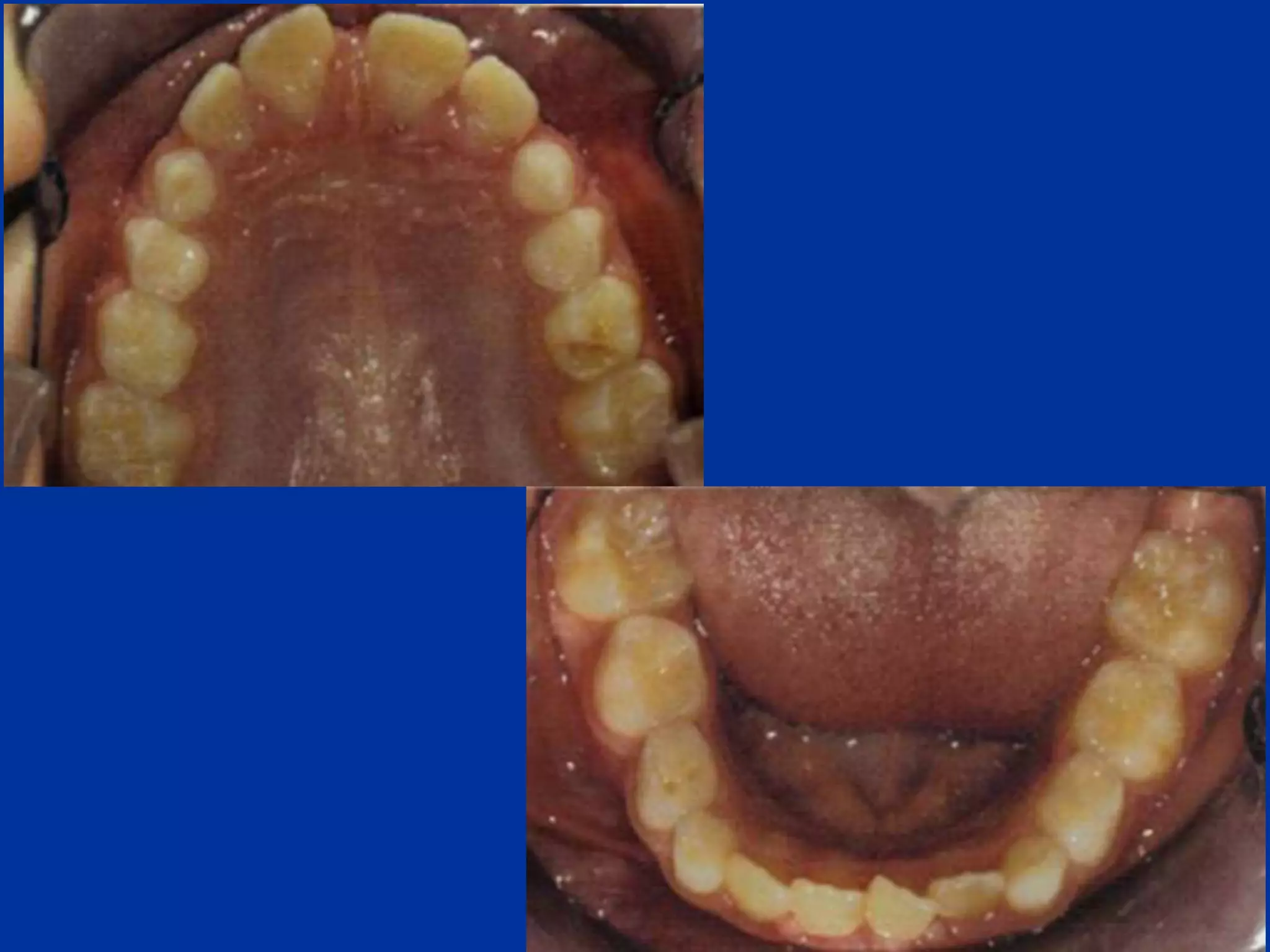 Growth modification of different types of malocclusion | PPTX