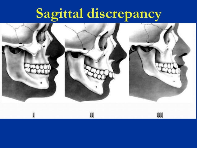 Growth modification of different types of malocclusion | PPTX
