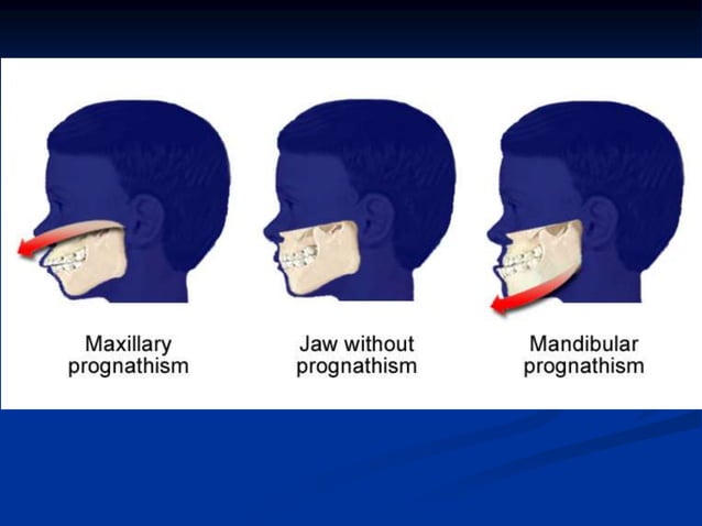 Growth modification of different types of malocclusion | PPTX