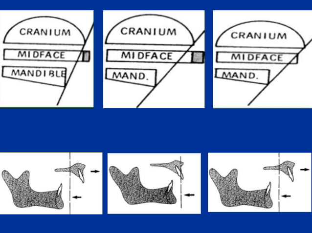 Growth modification of different types of malocclusion | PPTX