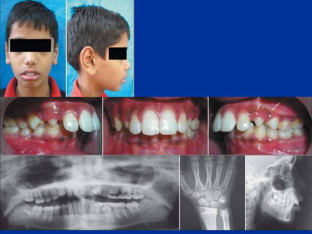 Growth modification of different types of malocclusion | PPTX