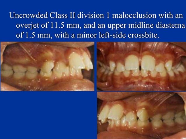 Growth modification of different types of malocclusion | PPTX