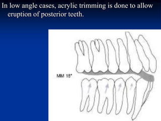Growth modification of different types of malocclusion | PPTX