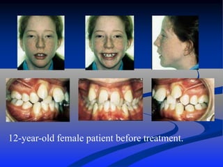 Growth modification of different types of malocclusion | PPTX