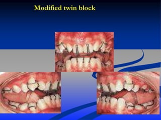 Growth modification of different types of malocclusion | PPTX