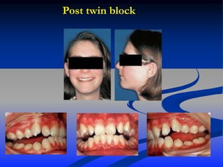 Growth modification of different types of malocclusion | PPTX