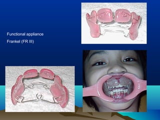 Growth Modification Treatment | PPT