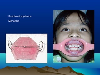 Growth Modification Treatment | PPT