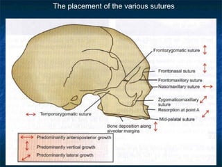 Nasomaxillary Suture