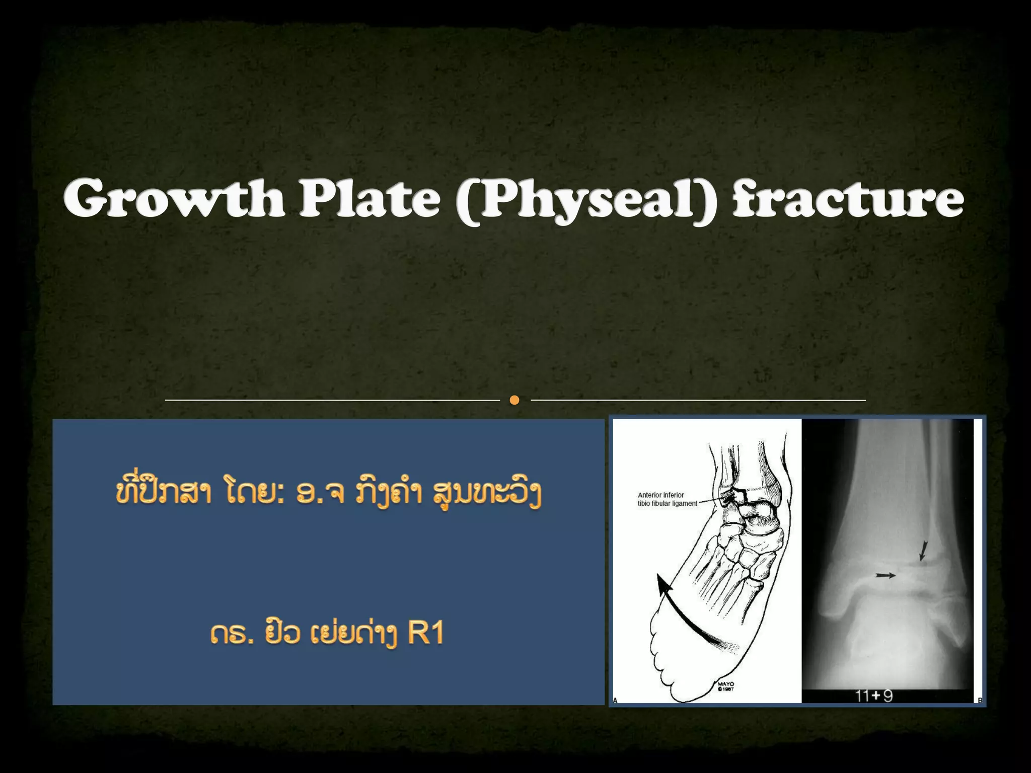 Growth plate (physeal) fracture | PDF