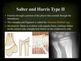 Growth plate (physeal) fracture | PDF
