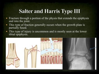 Growth plate (physeal) fracture | PDF