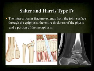 Growth plate (physeal) fracture | PDF