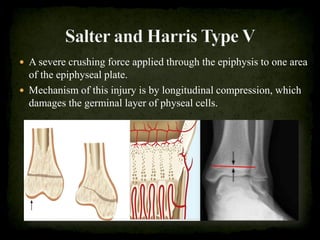 Growth plate (physeal) fracture | PDF