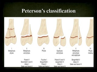 Growth plate (physeal) fracture | PDF