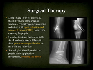 Growth plate (physeal) fracture | PDF