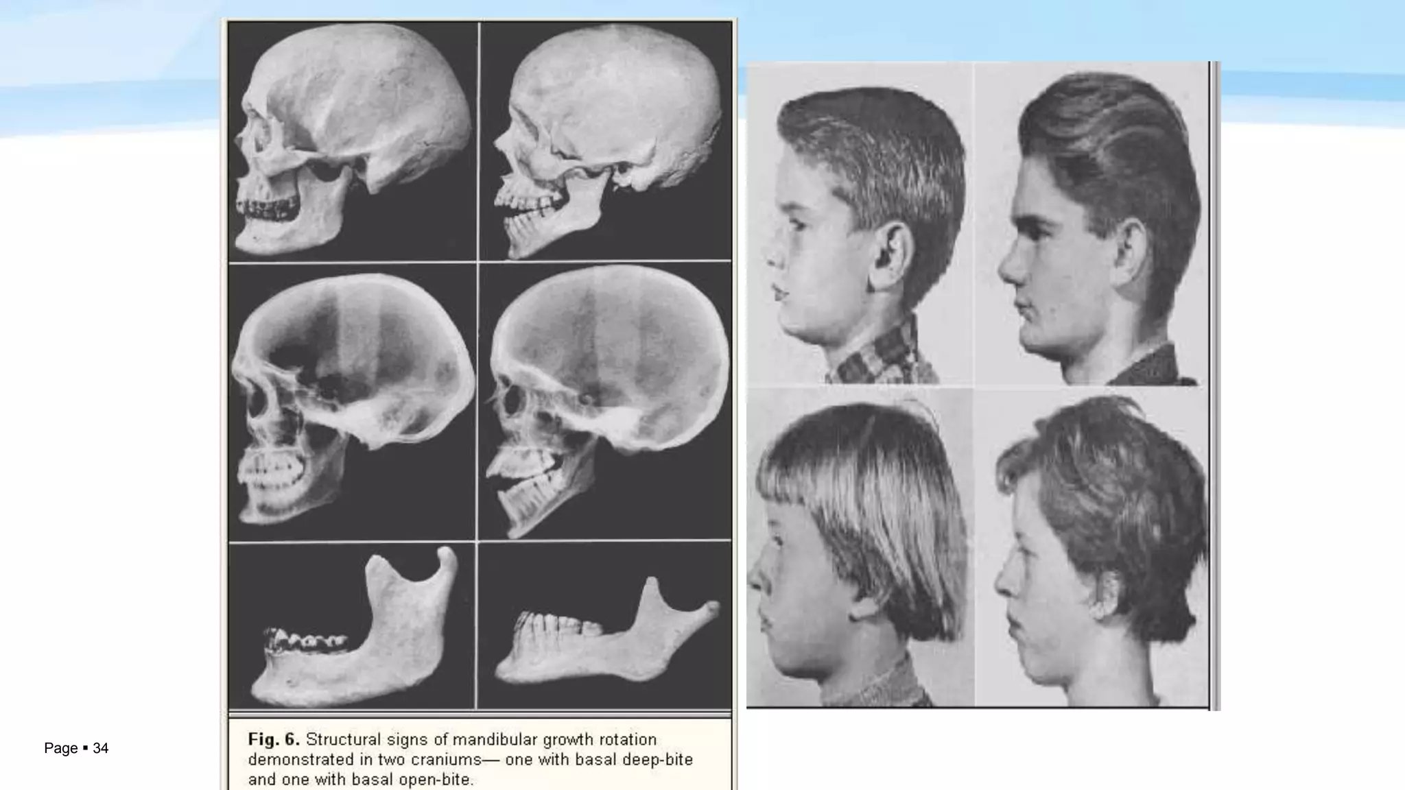 Growth rotations in orthodontics | PPTX