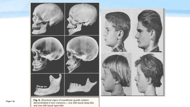 Growth rotations in orthodontics | PPTX