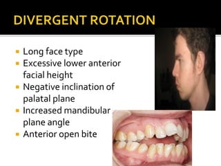 Growth rotations of the jaws | PPTX
