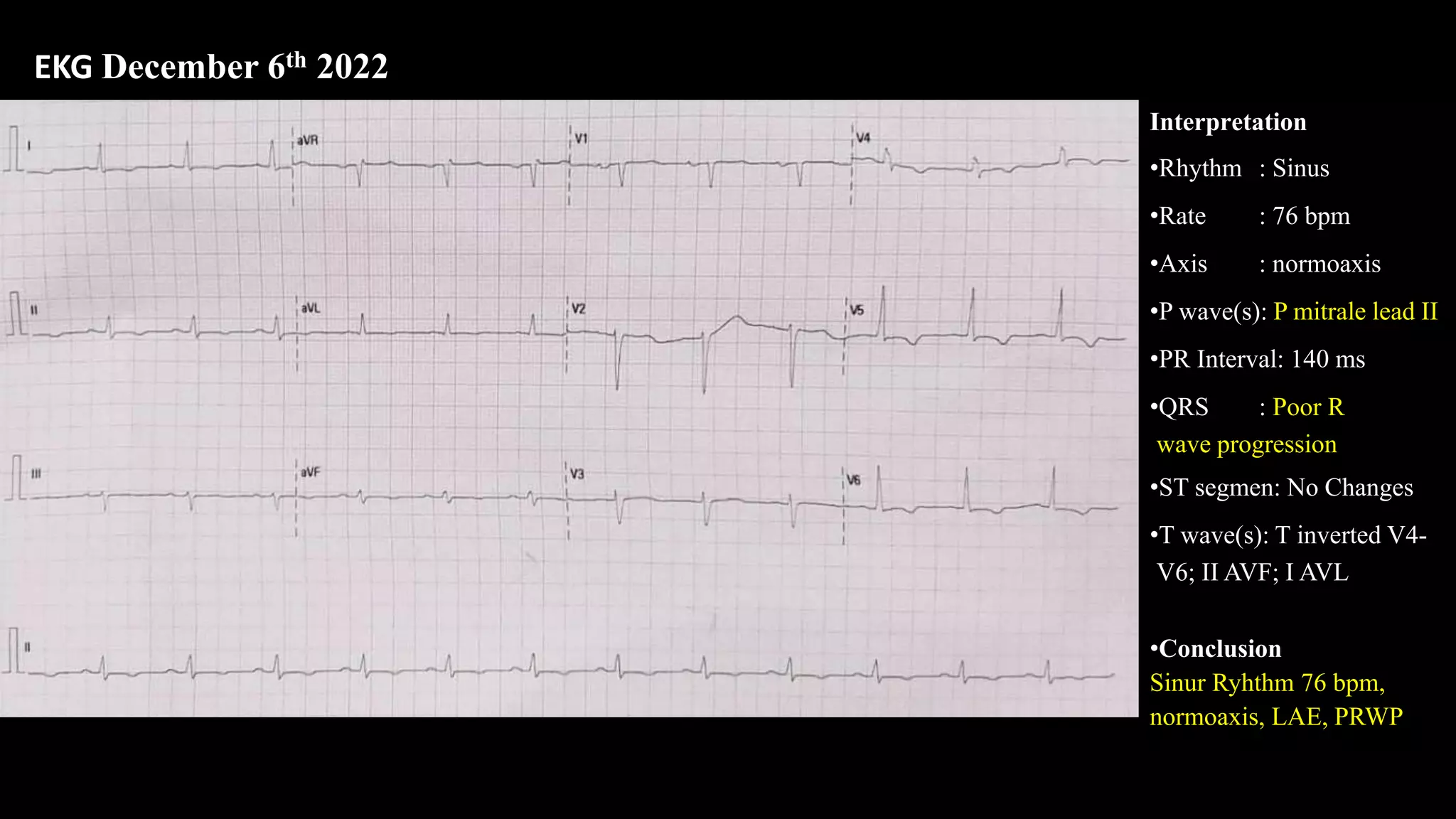 Post partum cardiomyopathypptx | PPTX
