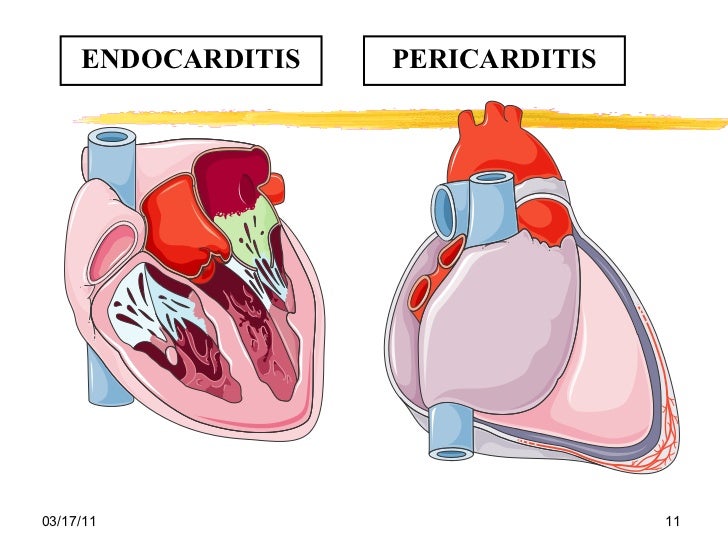 14. Pericarditis & Endocarditis & Valvular heart disease : 네이버 블로그