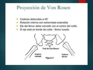 TECNICA DE VON ROSEN.pptx