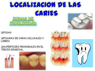 caries dental | PPTX