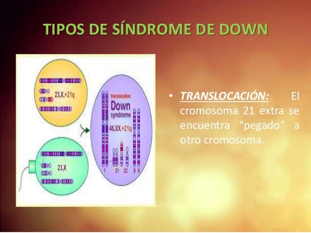 Sindrome de Down