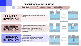 CICATRIZACION DE HERIDAS | PPTX