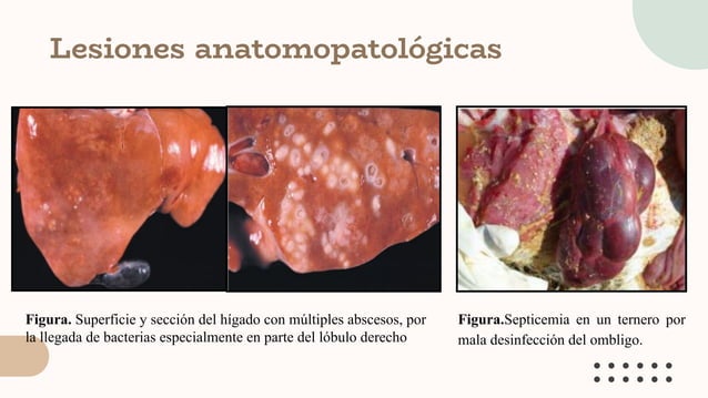 Onfalitis (Onfaloflebitis, Onfaloarteritis) | PDF
