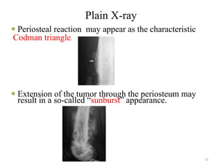 Osteosarcoma Sunray Appearance