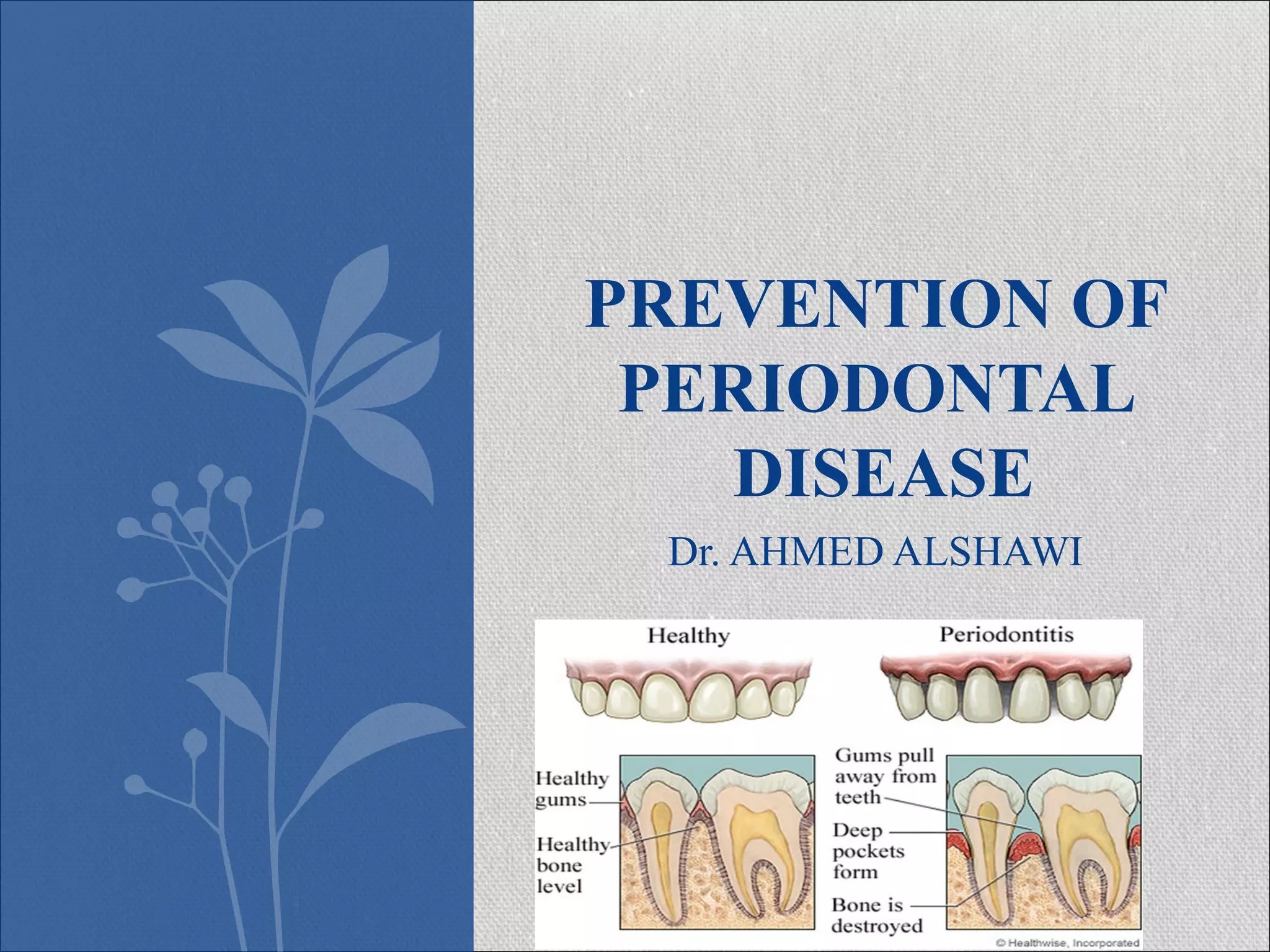 5 prevention of periodontal disease | PPT
