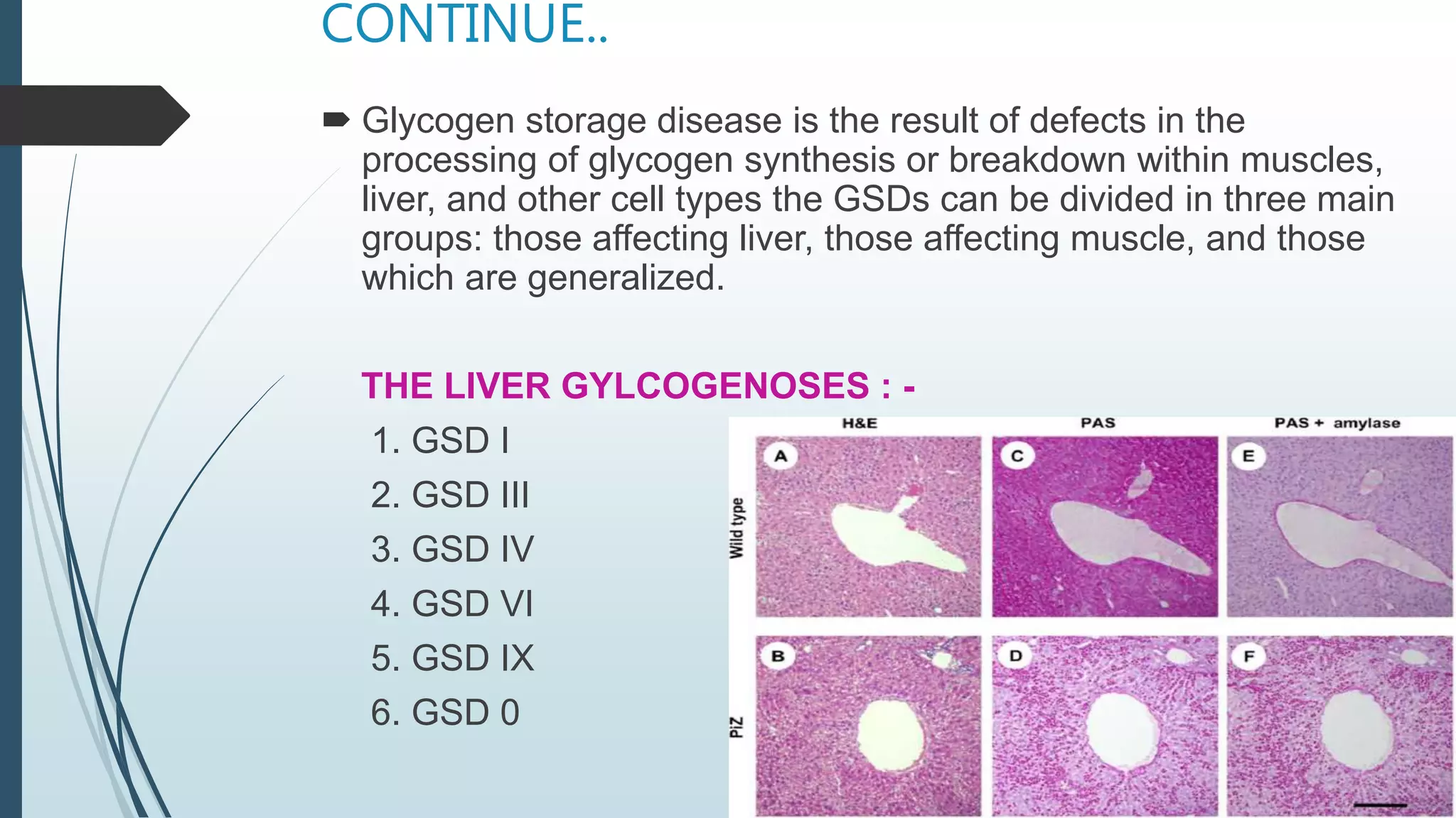 Glycogen Storage Disease Gsd Von Gierke Disease Ppt